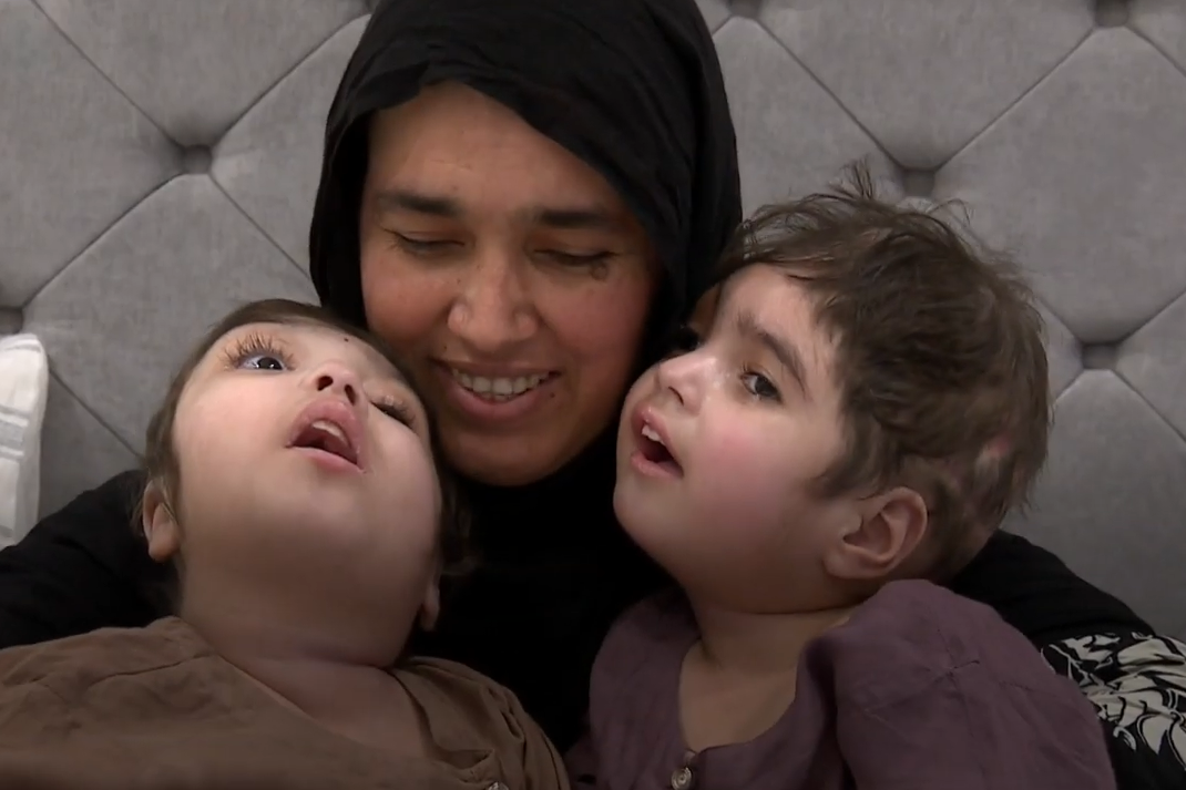 Doctors Fight 50 Hours To Save The Lives Of Twins Conjoined At The Head ...